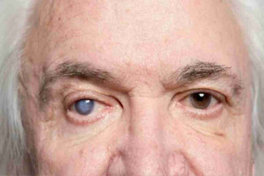 O que é Catarata? Saiba quais são os sintomas, diagnóstico e tratamento